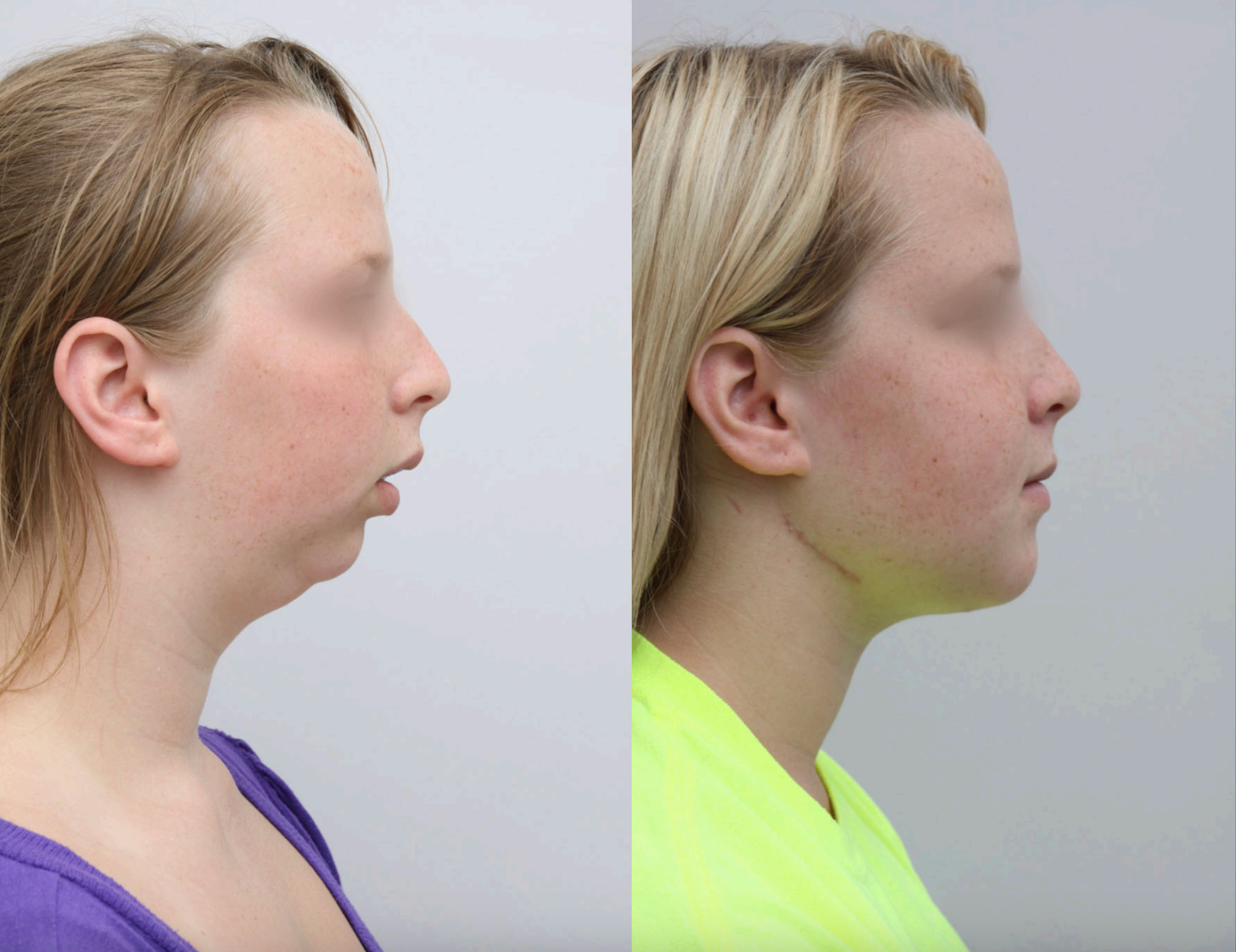 Jaw Surgery Jackson MS | Corrective Jaw Surgery in Jackson