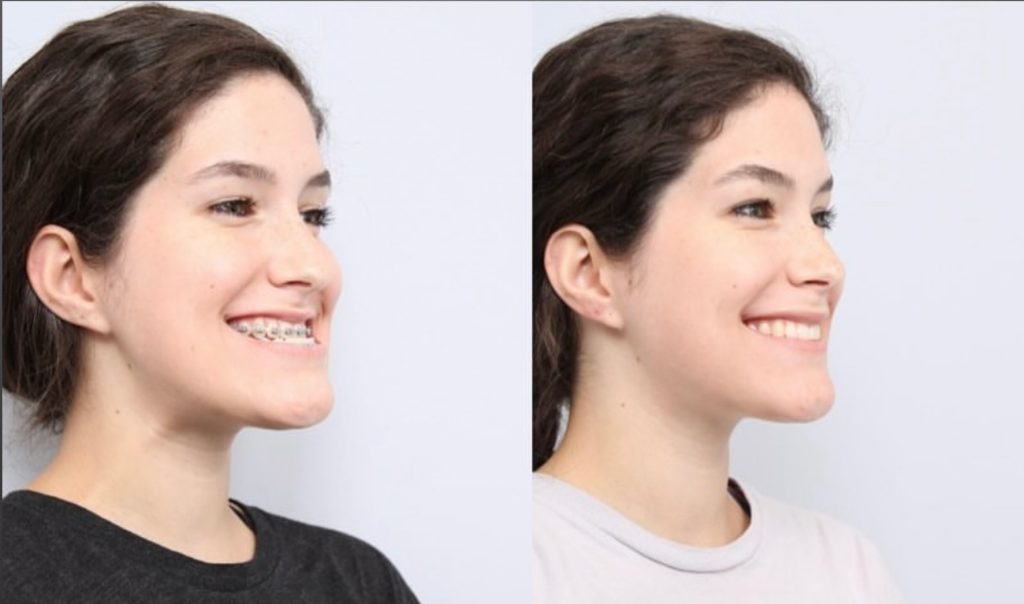 Before & After Gallery Jackson MS, Aligned Oral and Facial Surgery